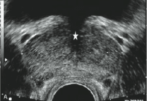 Especialista en Biopsia de Próstata | Urólogo en México | Dr. Patricio Cruz
