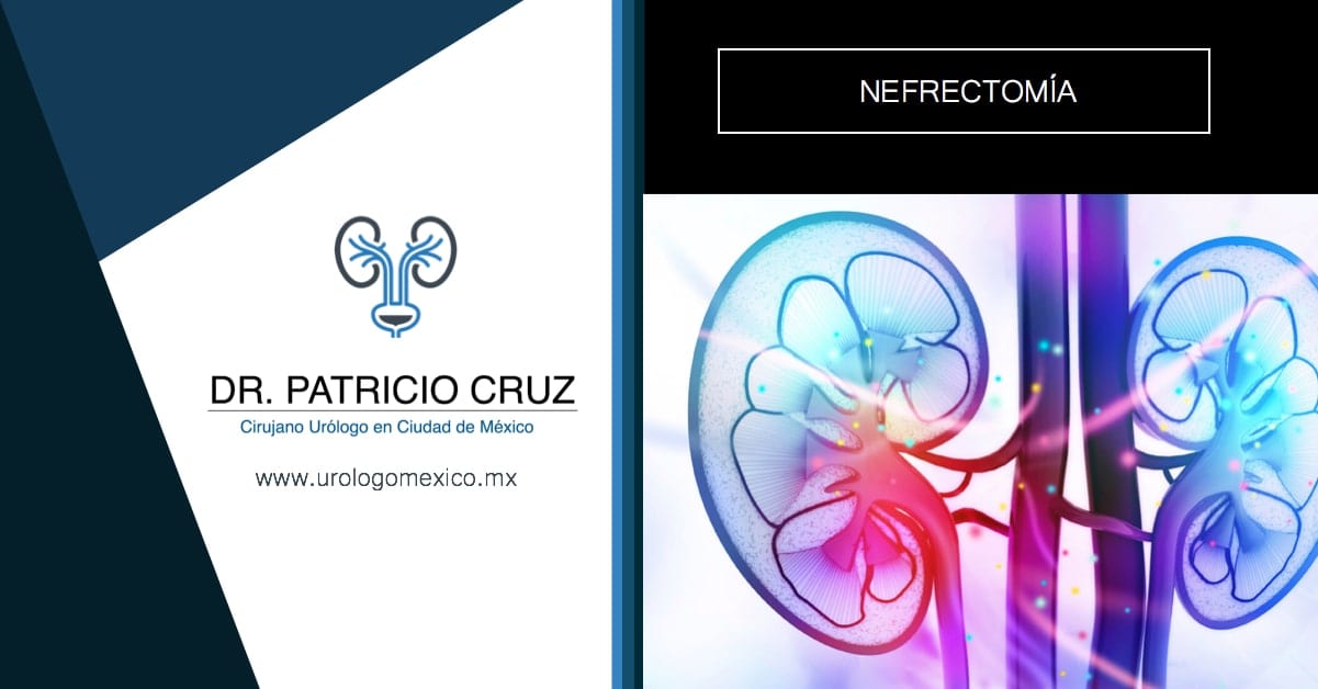 Nefrectomía | Dr. Patricio Cruz | Cirujano Urólogo México